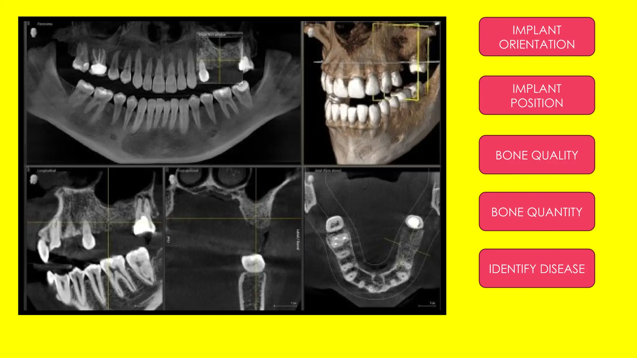 IMPLANT IMAGING (DENTAL IMPLANT IMAGING)- DR PRIYANKA | PPTX
