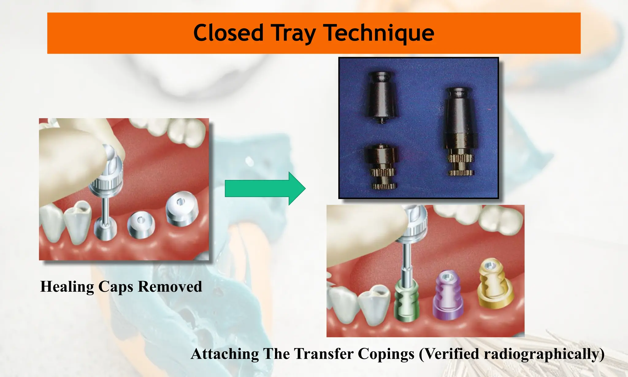 Dental Implant Impression techniques.pptx