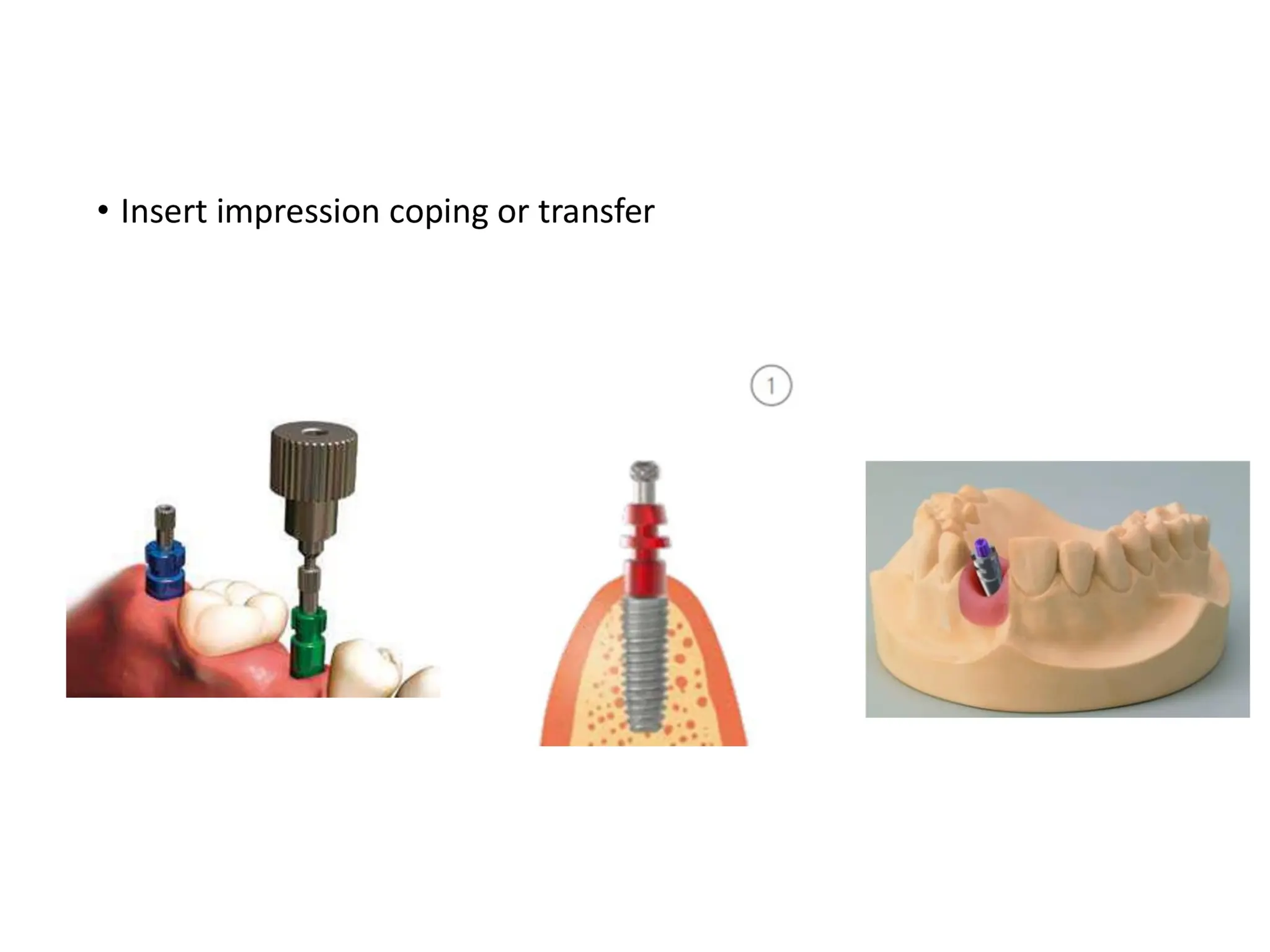 different implant impression techniques.pptx