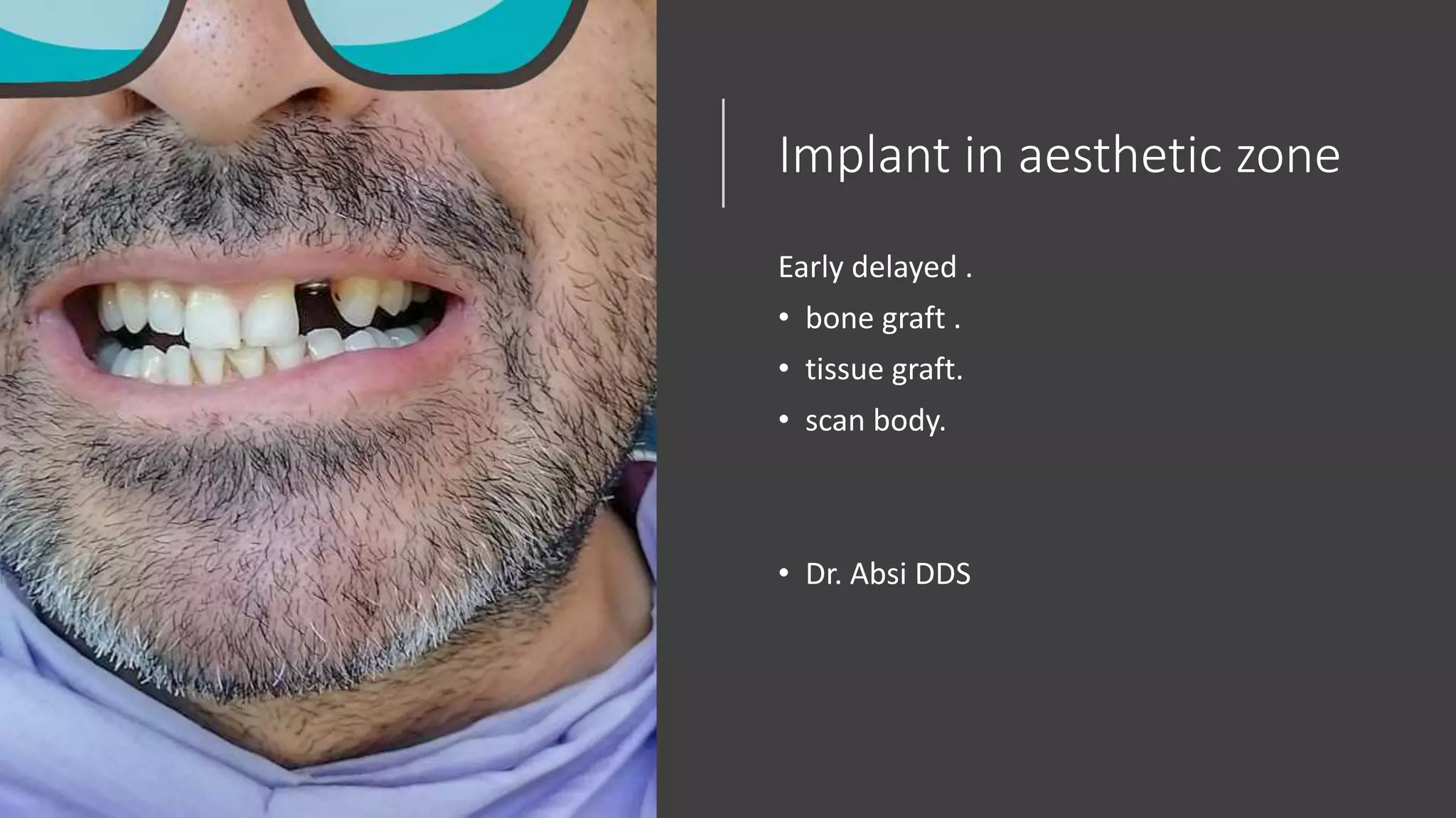 Implant in aesthetic zone | PPTX