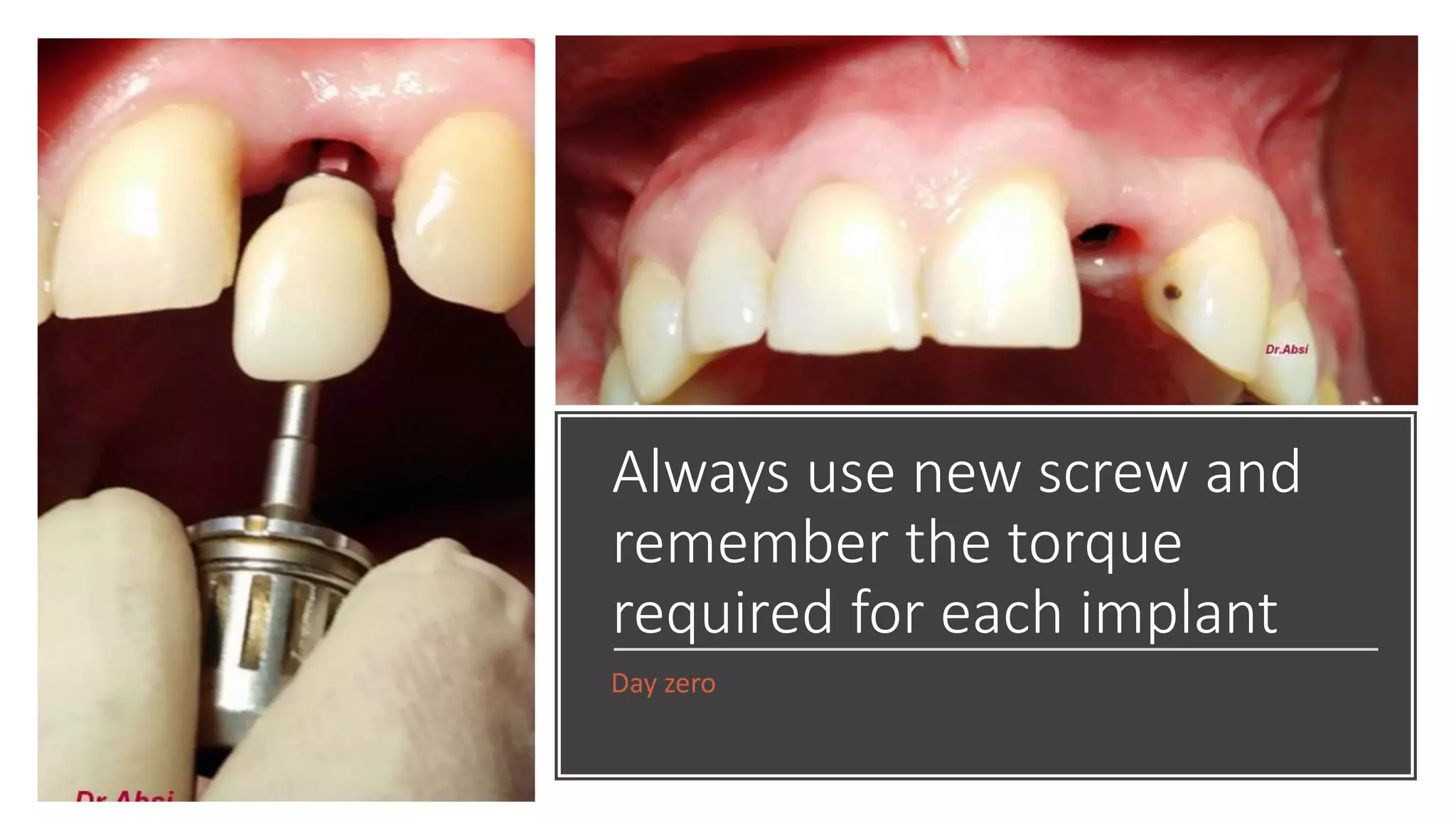 Implant in aesthetic zone | PPTX