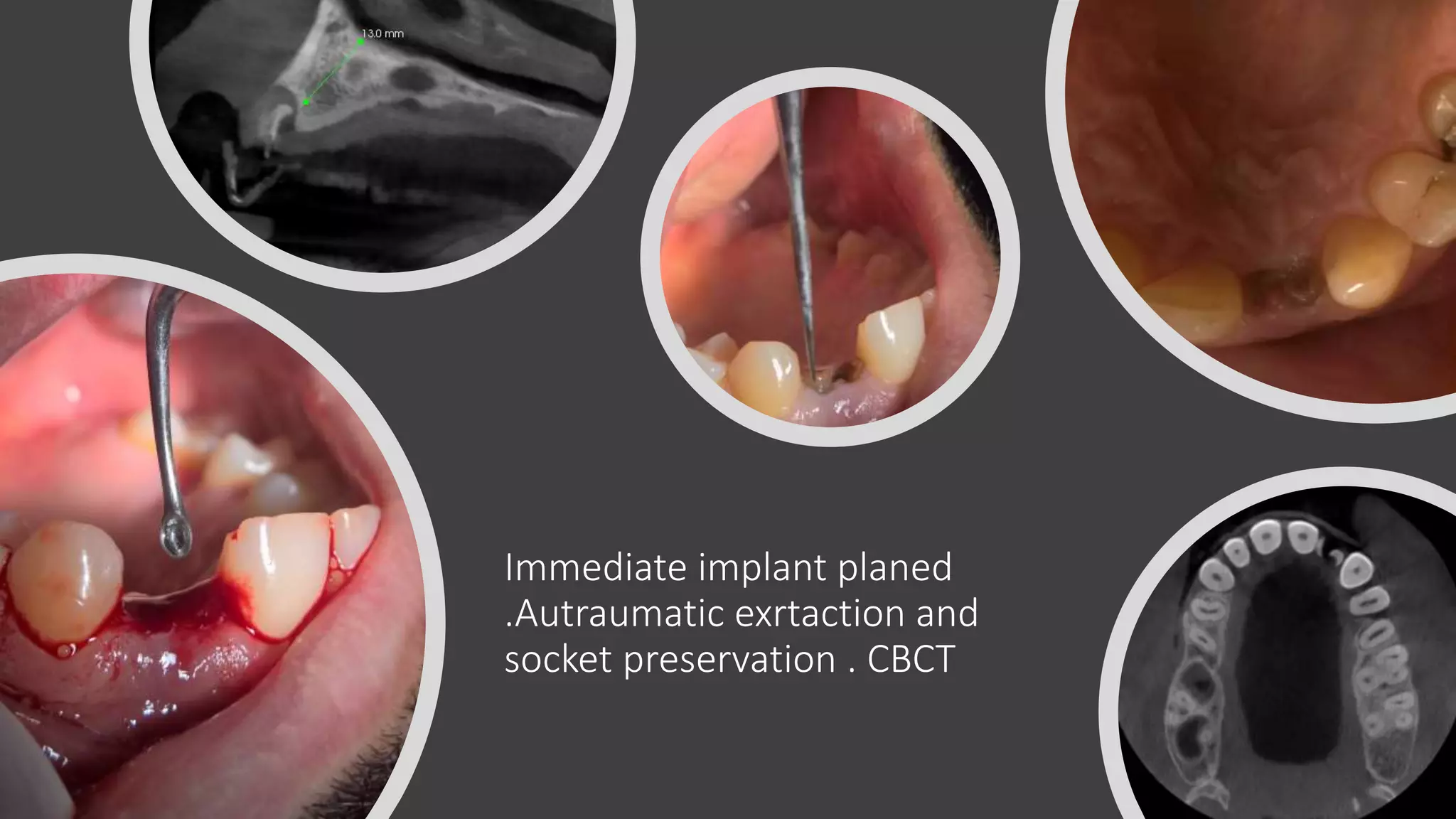 Implant in aesthetic zone | PPTX