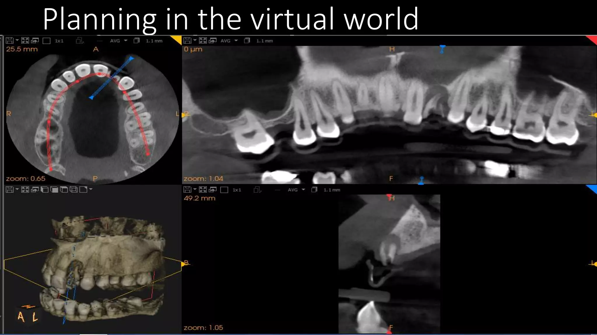 Implant in aesthetic zone | PPTX