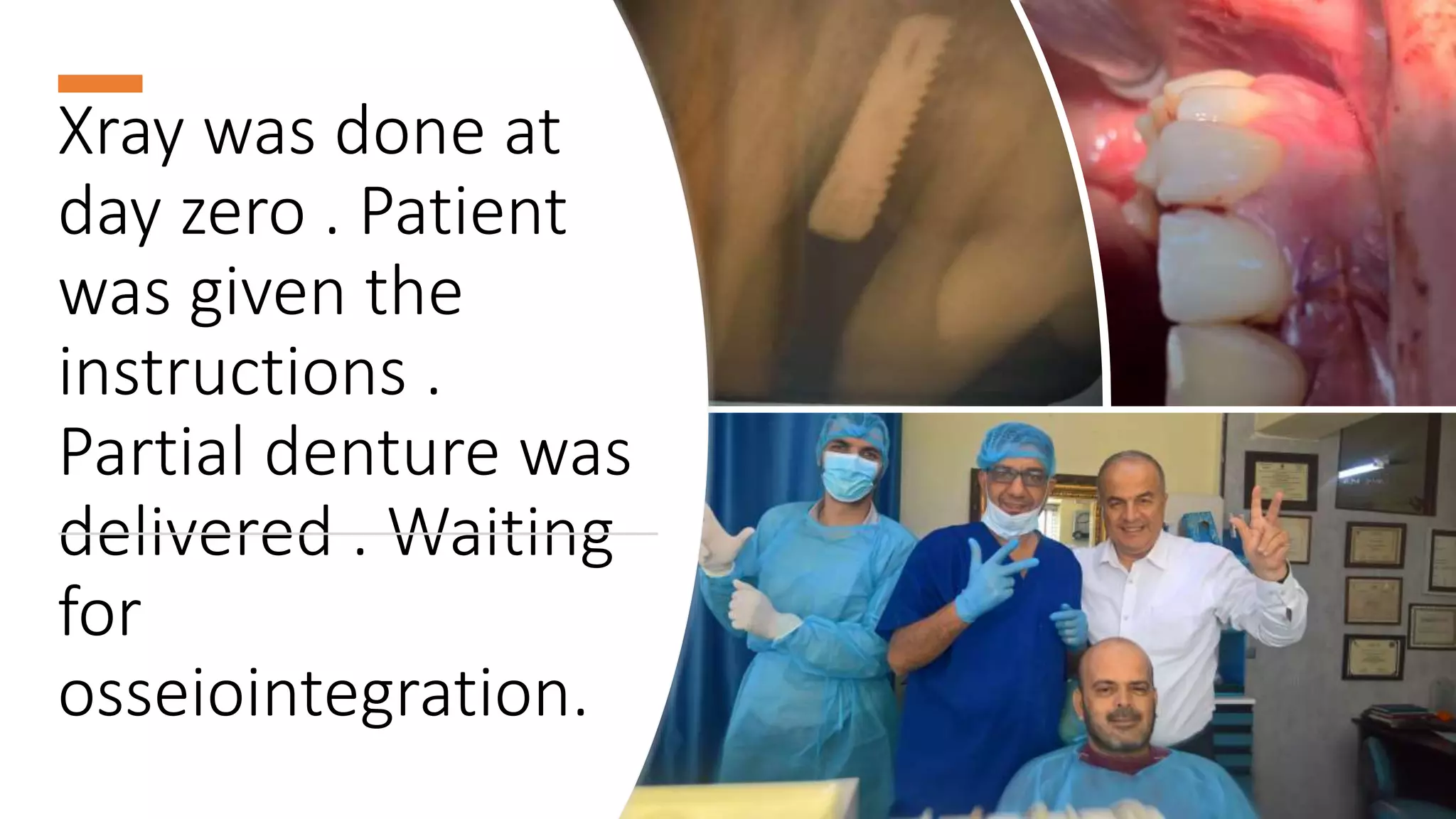 Implant in aesthetic zone | PPTX