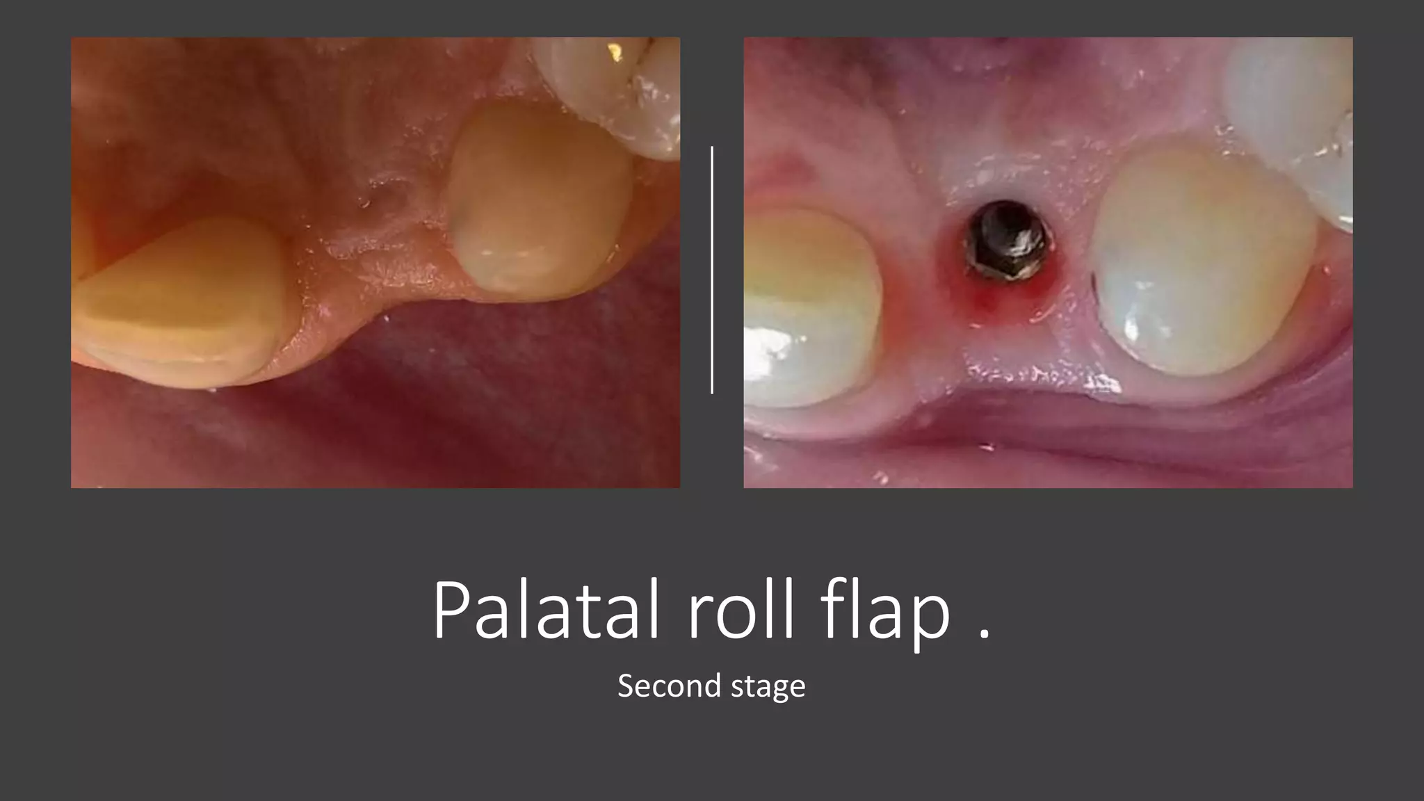 Implant in aesthetic zone | PPTX