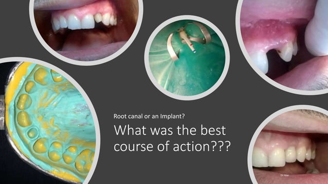 Implant in aesthetic zone | PPTX