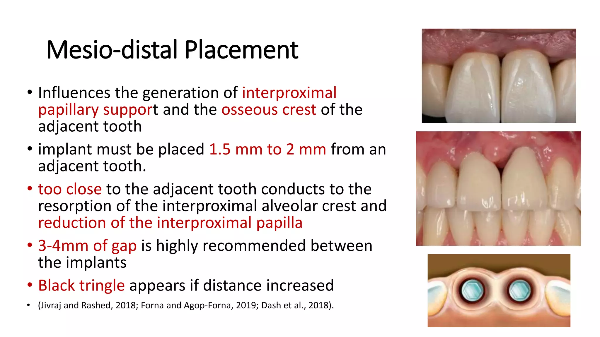 implant in esthetic zone ppt.pptx