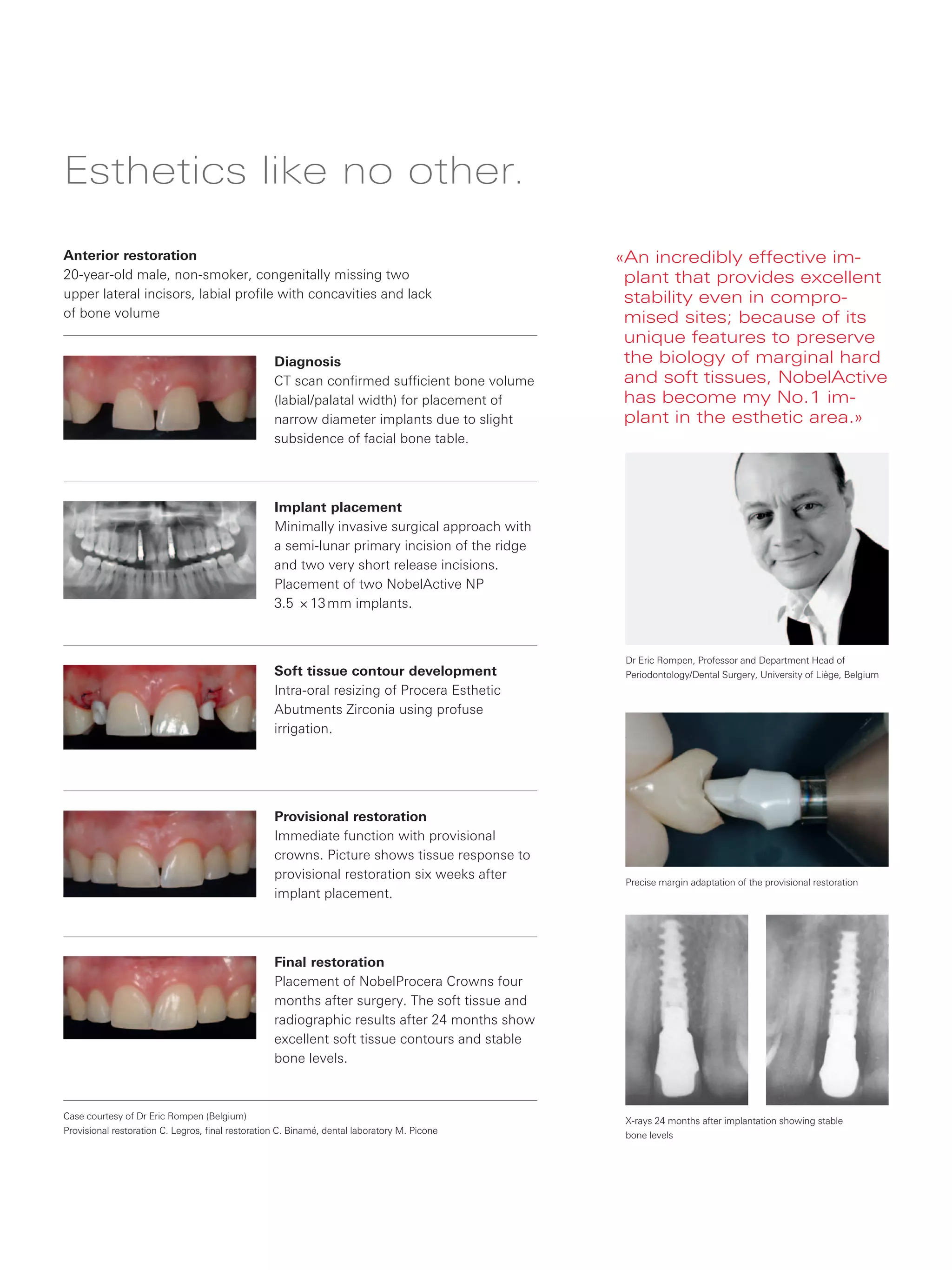 Dental Implant like no other | PDF