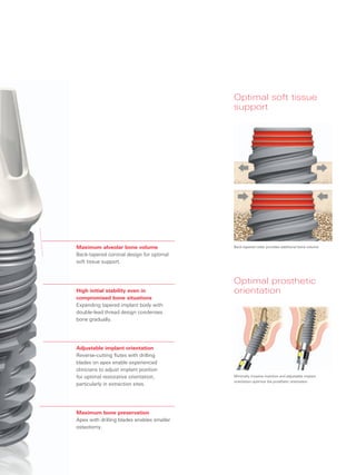 Dental Implant like no other | PDF | Dental Health | Diseases and ...