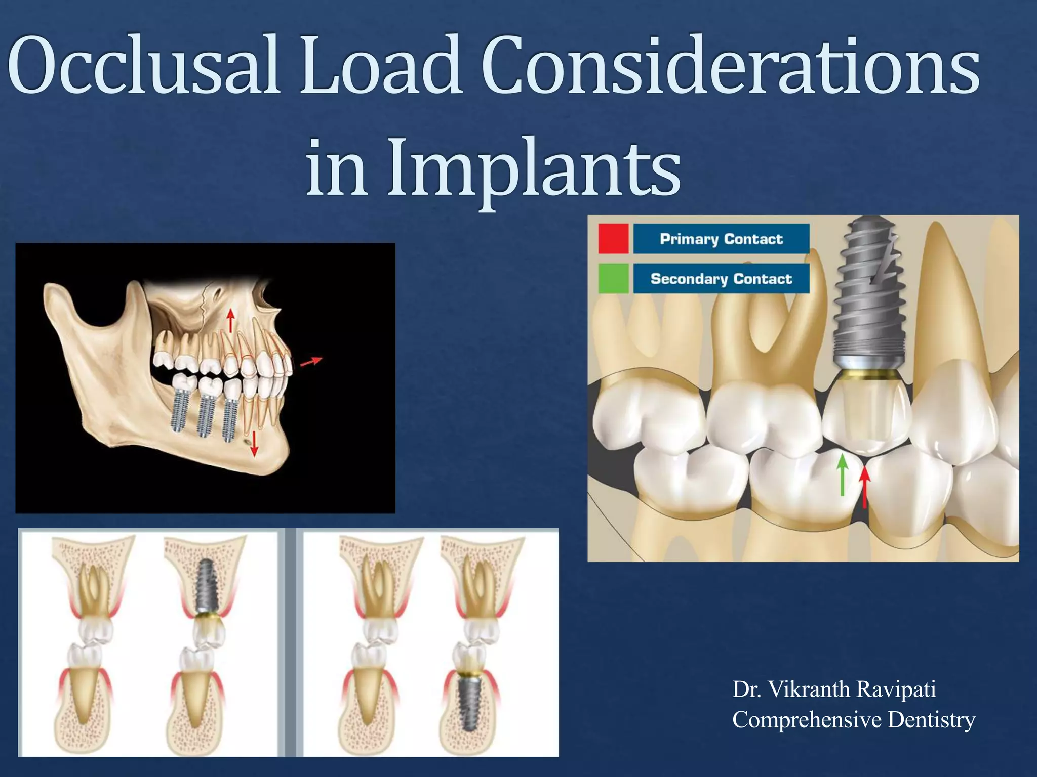 Implant Occlusion.pptx