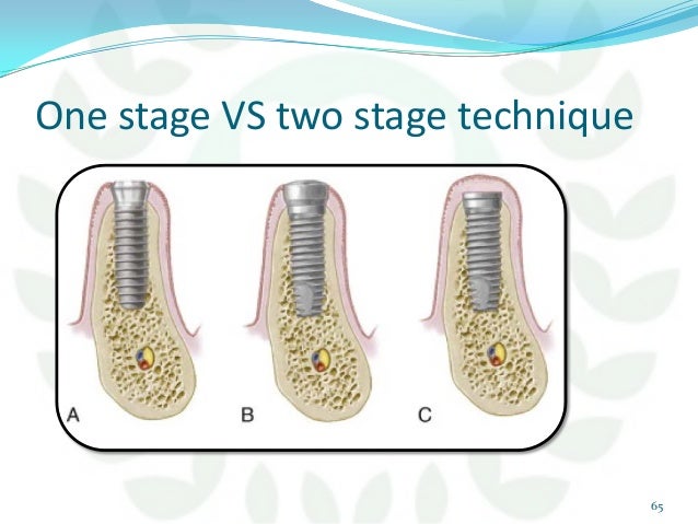 Implantology Simplified- All you need to know about Dental Implant