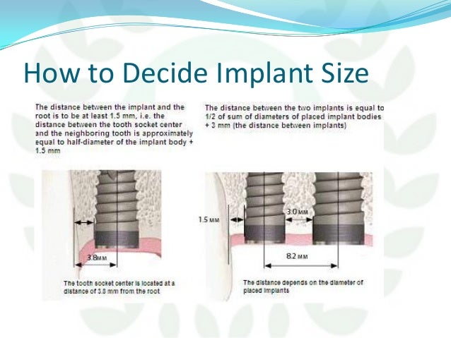 Everything About Dental Implantology- How to Put Dental Implants.