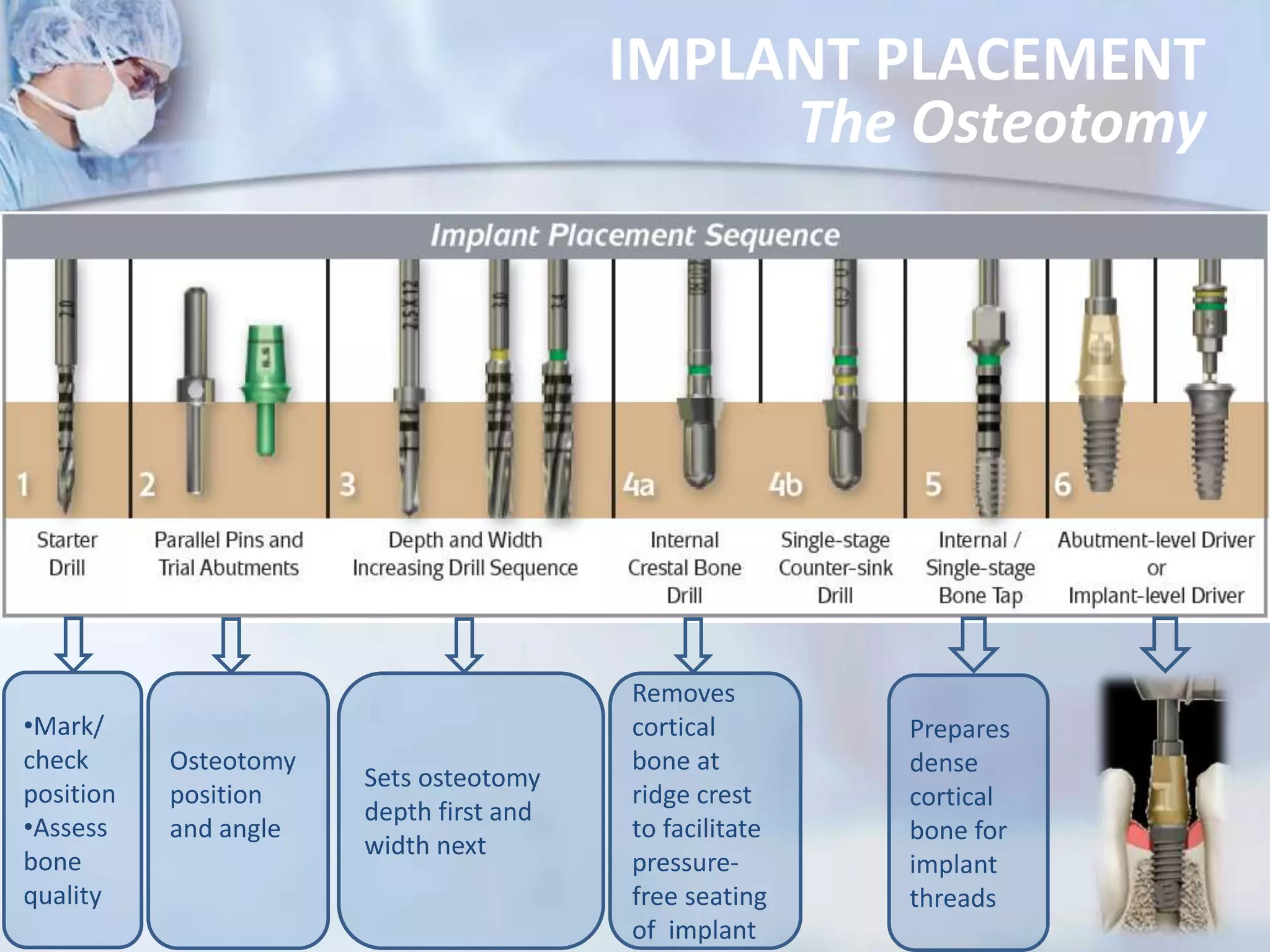 Implant placement | PPTX