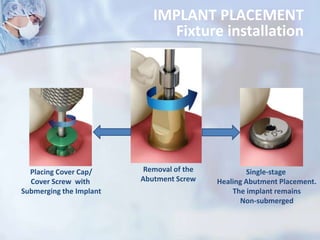 Implant placement | PPTX
