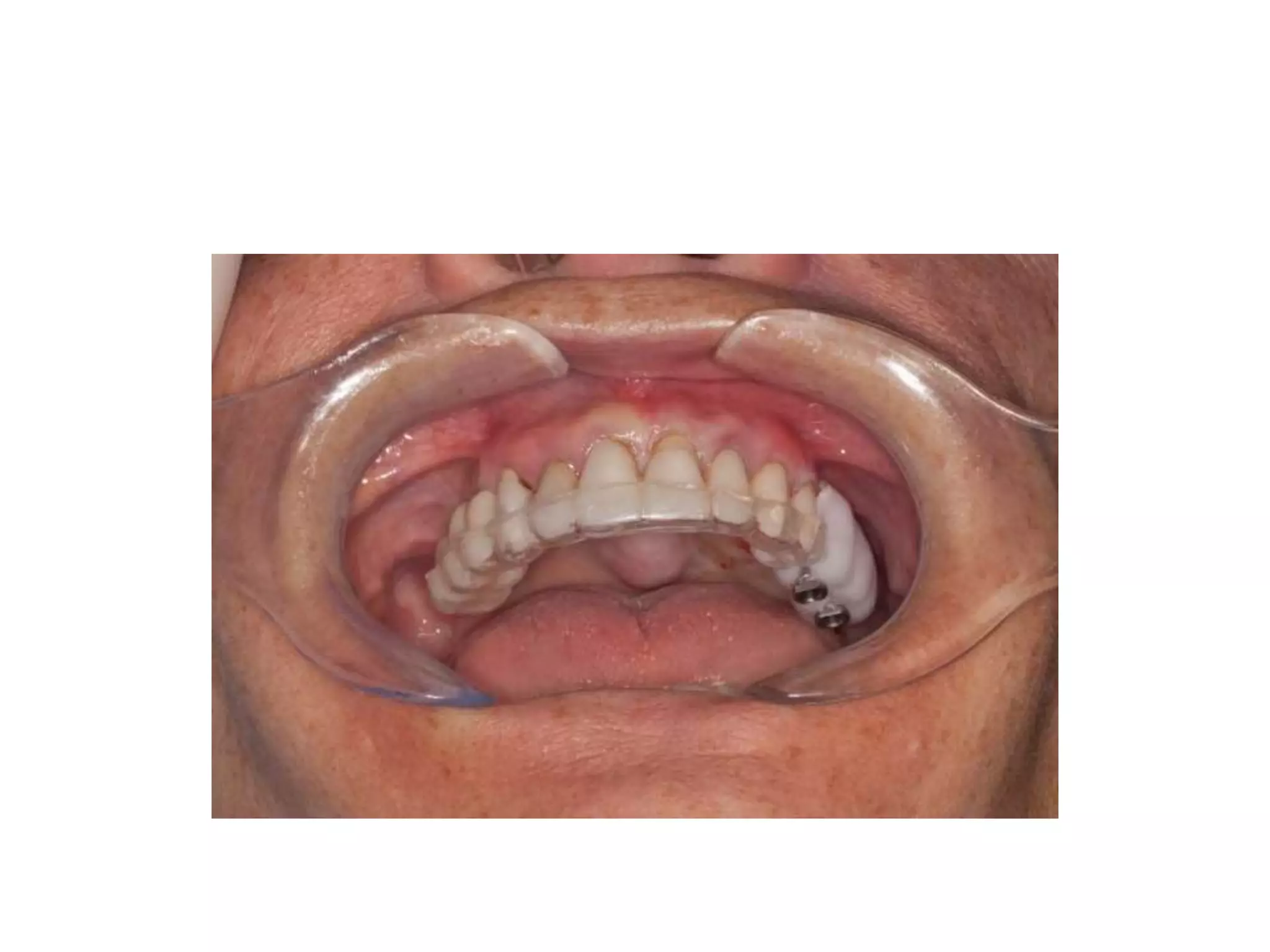Implant placement protocol | PPTX