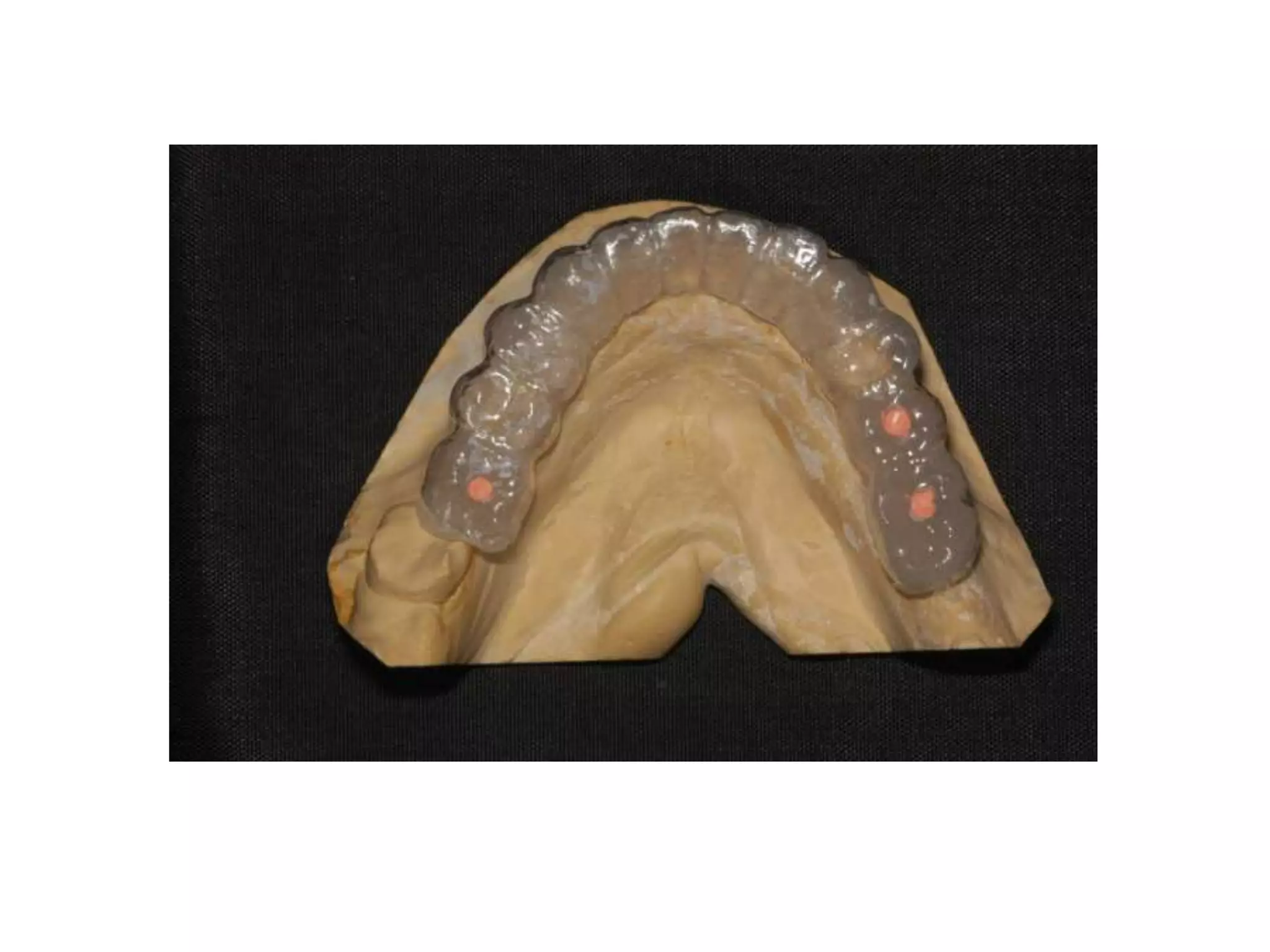 Implant placement protocol | PPTX