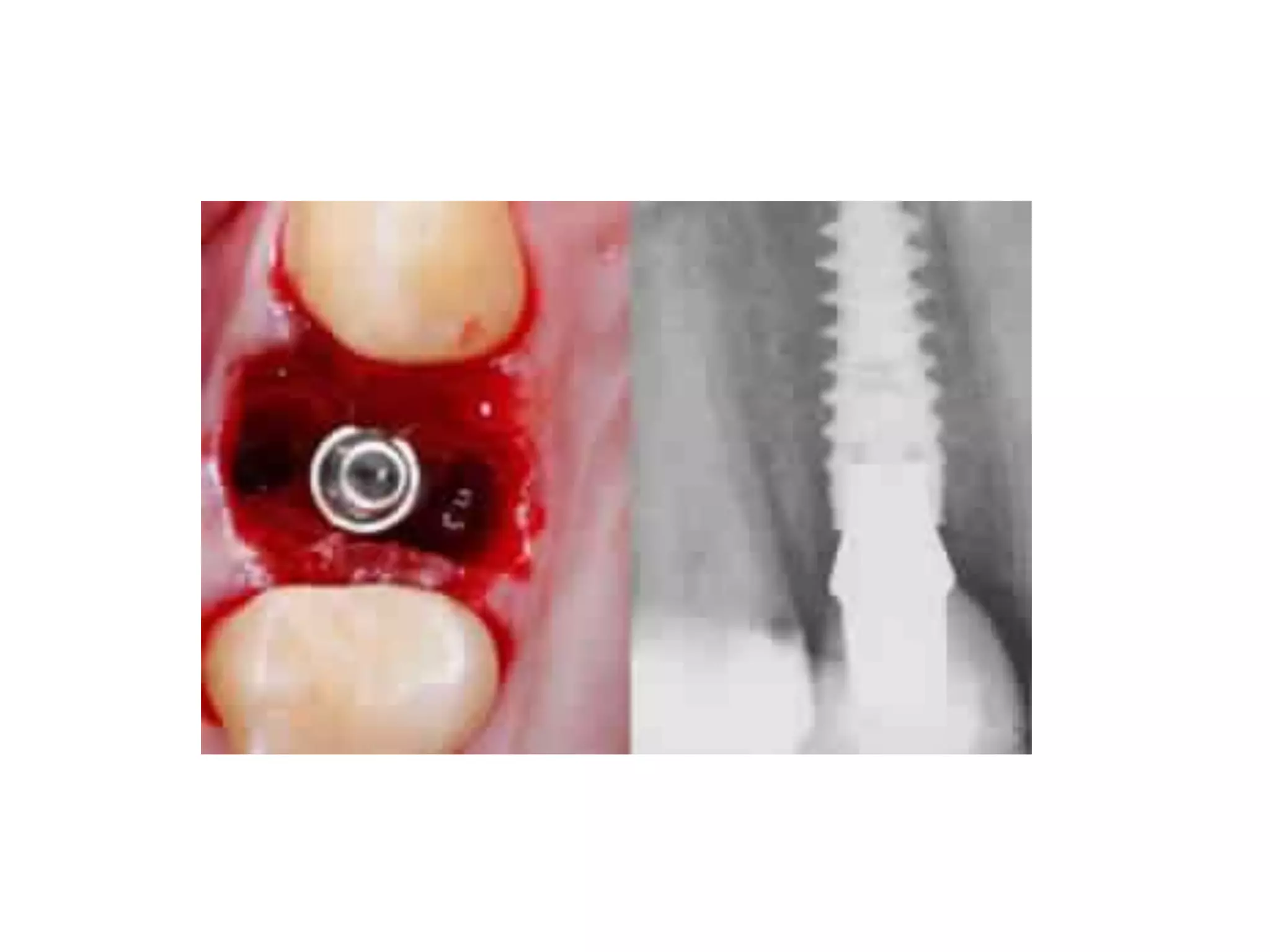 Implant placement protocol | PPTX