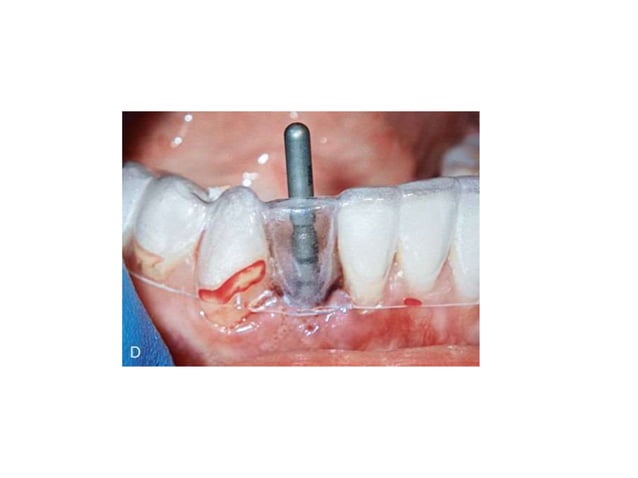 Implant placement protocol | PPTX