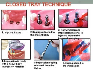 Implant prosthetic dentistry | PPTX