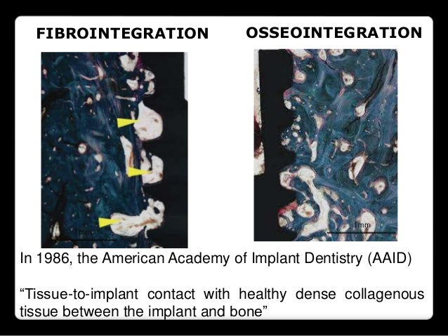 Implant quality scale ; osseointegration, success criteria and basic