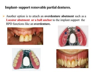Implant Removable Partial Dentures.pdf r | PDF