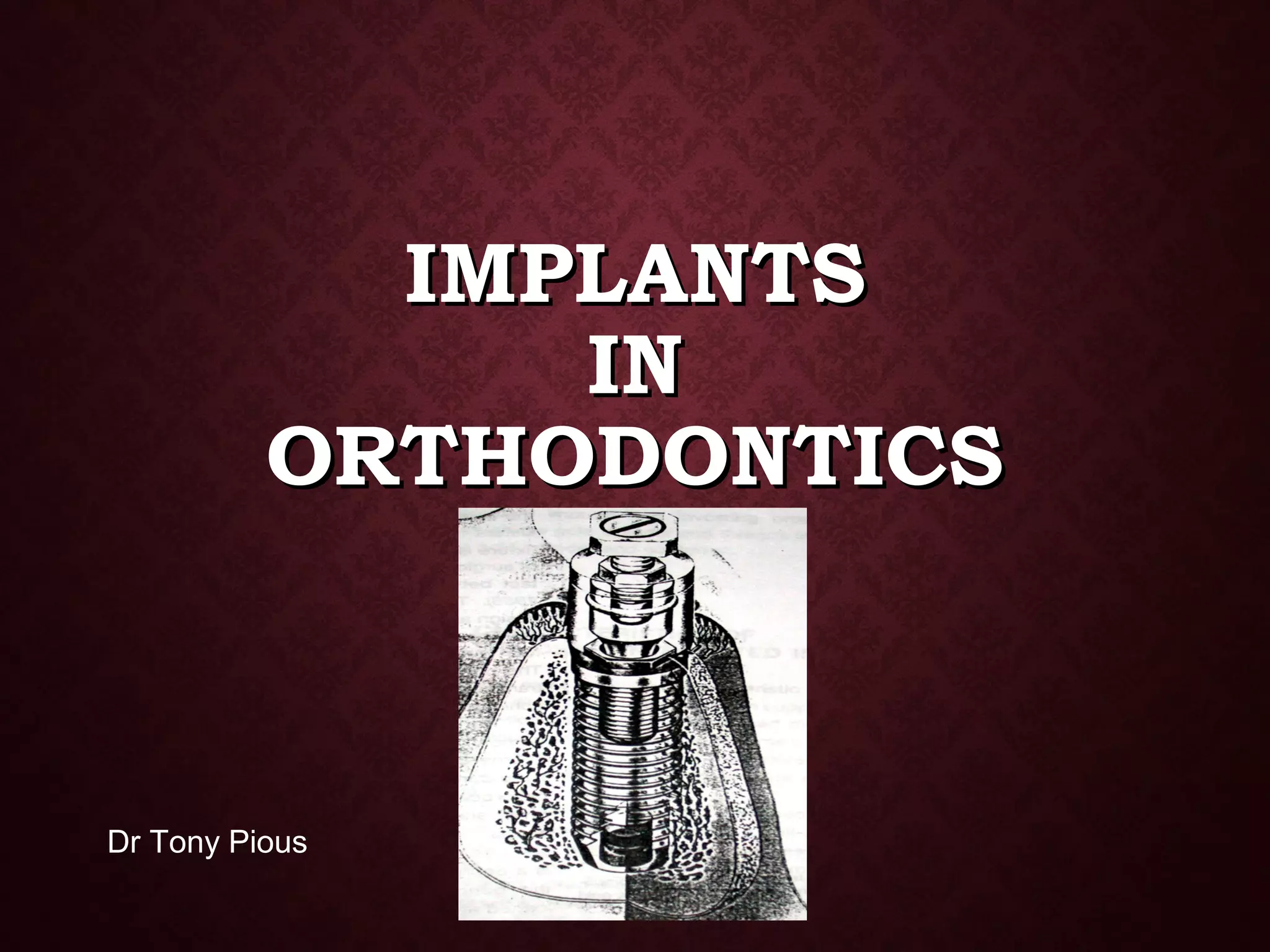 orthodontic Implants | PPT