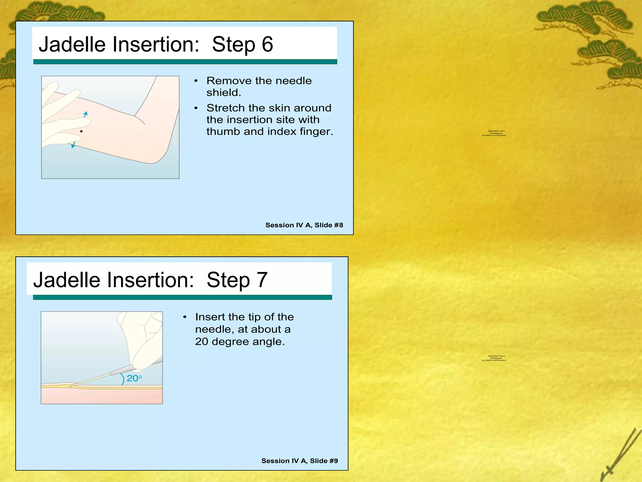 Implants.ppt3