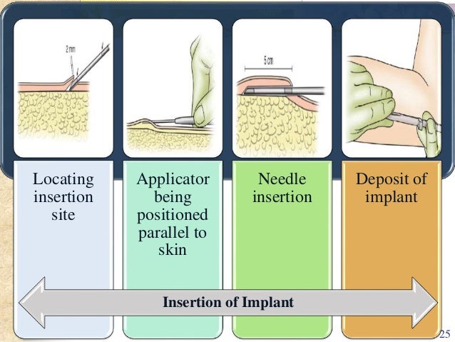 Implants