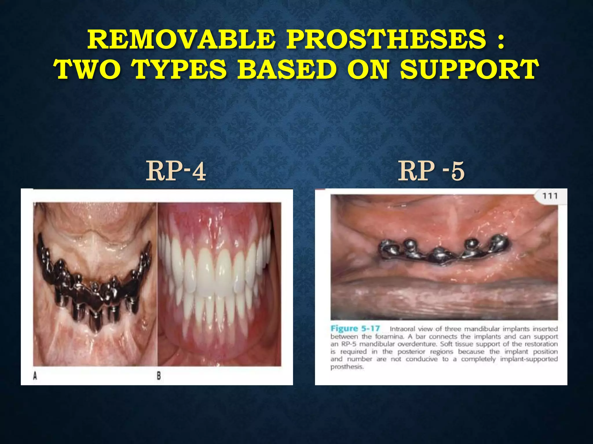 Implants : An Overview, Biomechanics & Treatment Planning | PPTX