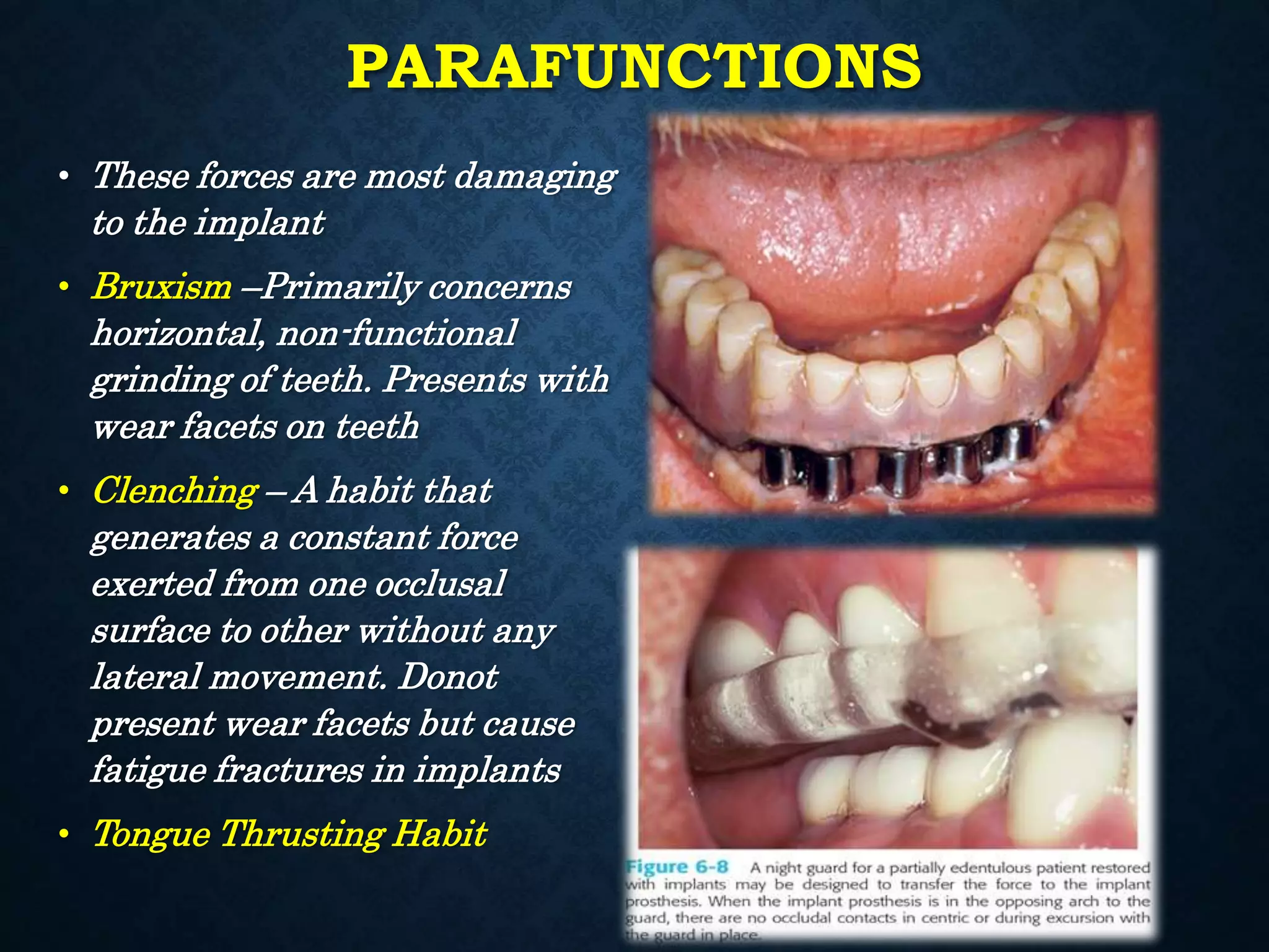 Implants : An Overview, Biomechanics & Treatment Planning | PPTX