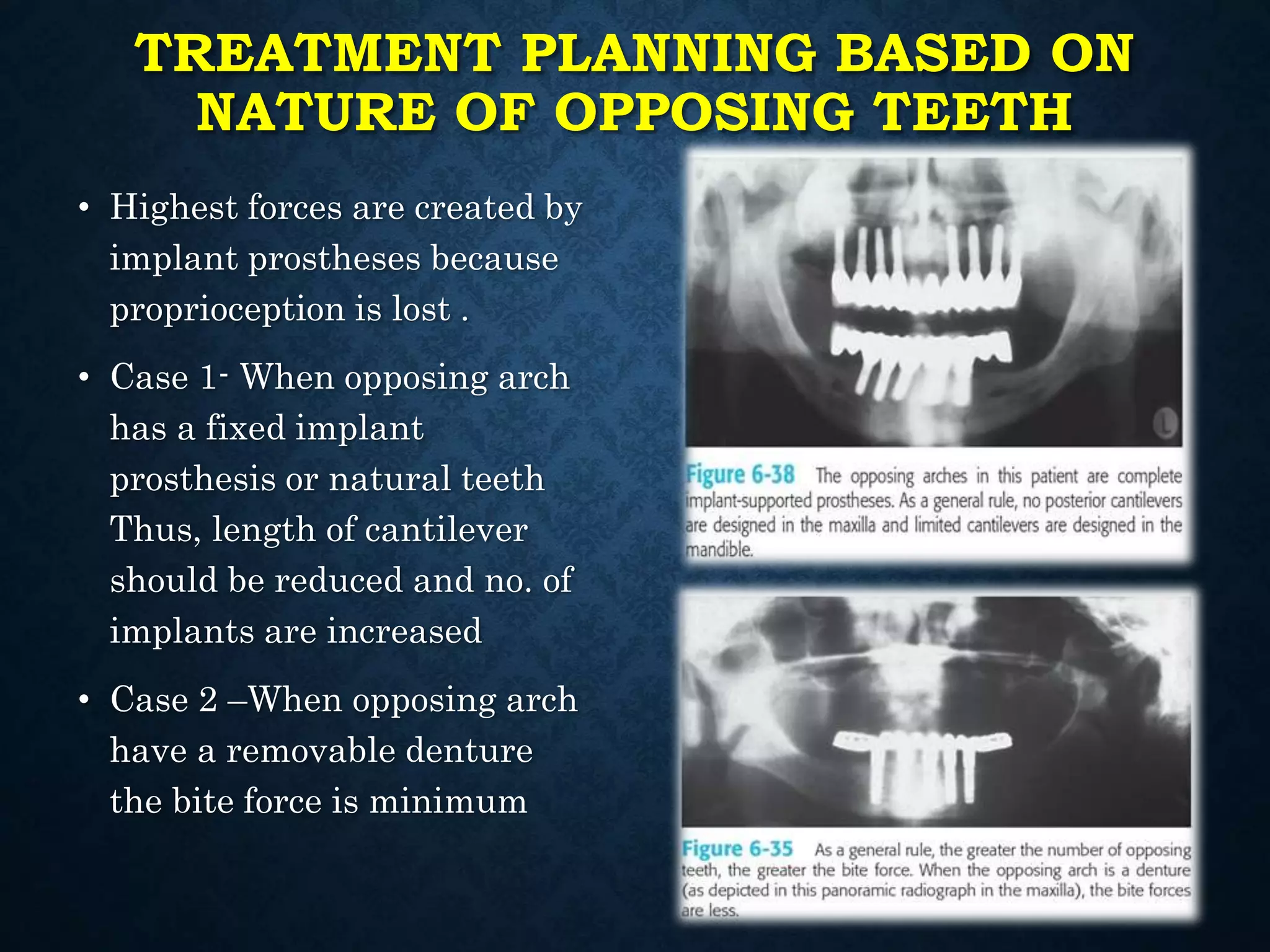 Implants : An Overview, Biomechanics & Treatment Planning | PPTX