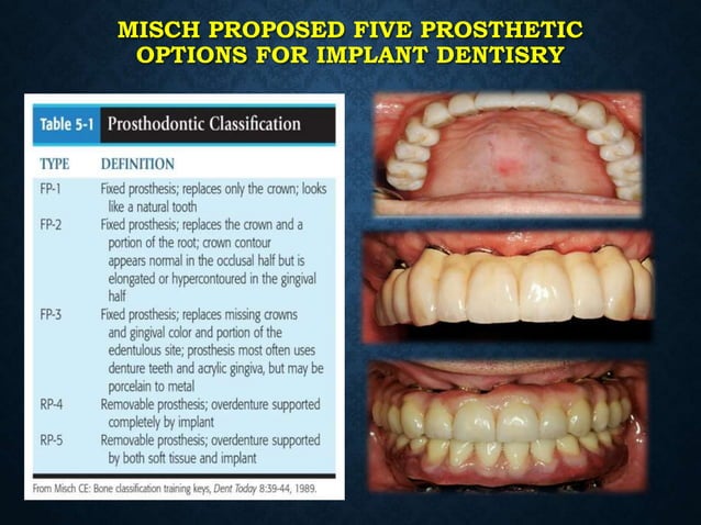 Implants : An Overview, Biomechanics & Treatment Planning | PPTX | Dental Health | Diseases and ...