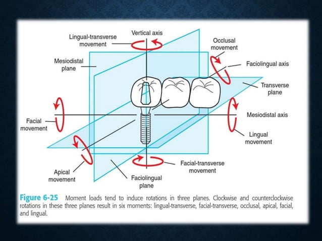 Implants : An Overview, Biomechanics & Treatment Planning | PPTX | Dental Health | Diseases and ...