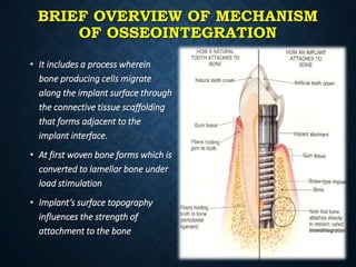 Implants : An Overview, Biomechanics & Treatment Planning | PPTX