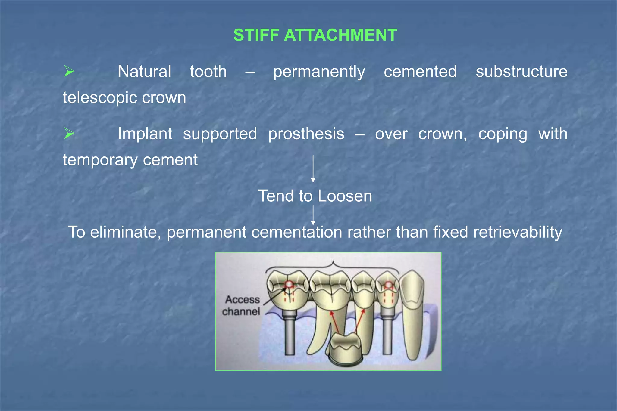 IMPLANTS-Biomechanics.ppt | Bone and Joint Conditions | Diseases and Conditions