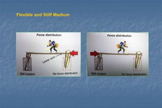IMPLANTS-Biomechanics.ppt
