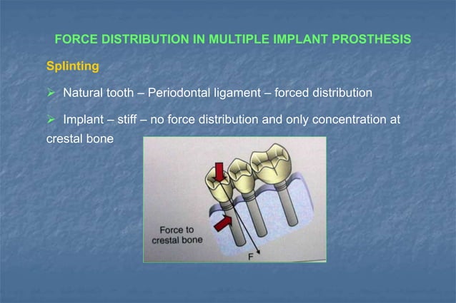 IMPLANTS-Biomechanics.ppt | Bone and Joint Conditions | Diseases and Conditions