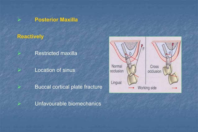 IMPLANTS-Biomechanics.ppt | Bone and Joint Conditions | Diseases and Conditions
