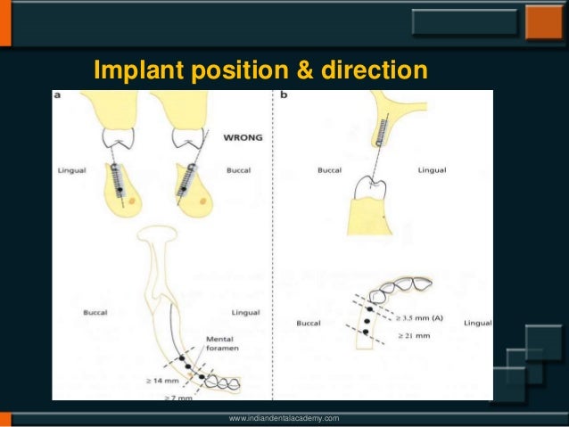 Dental Implants surgical considerations / implant dentistry course/ i…