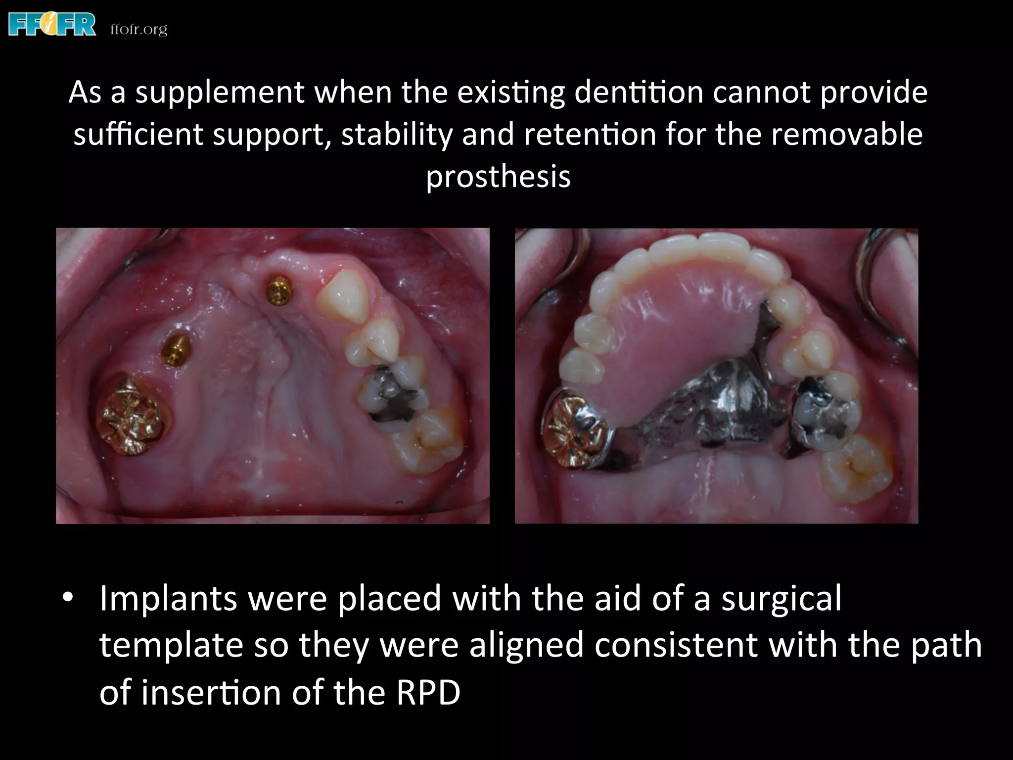 Implants and rp ds | PDF
