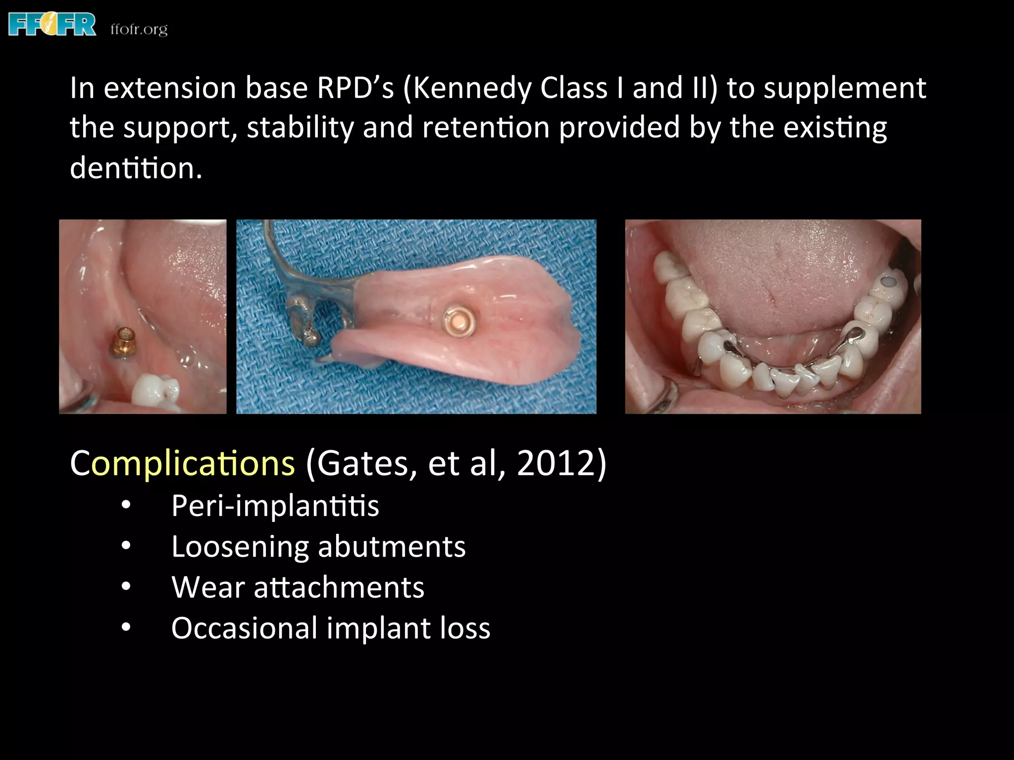 Implants and rp ds | PDF