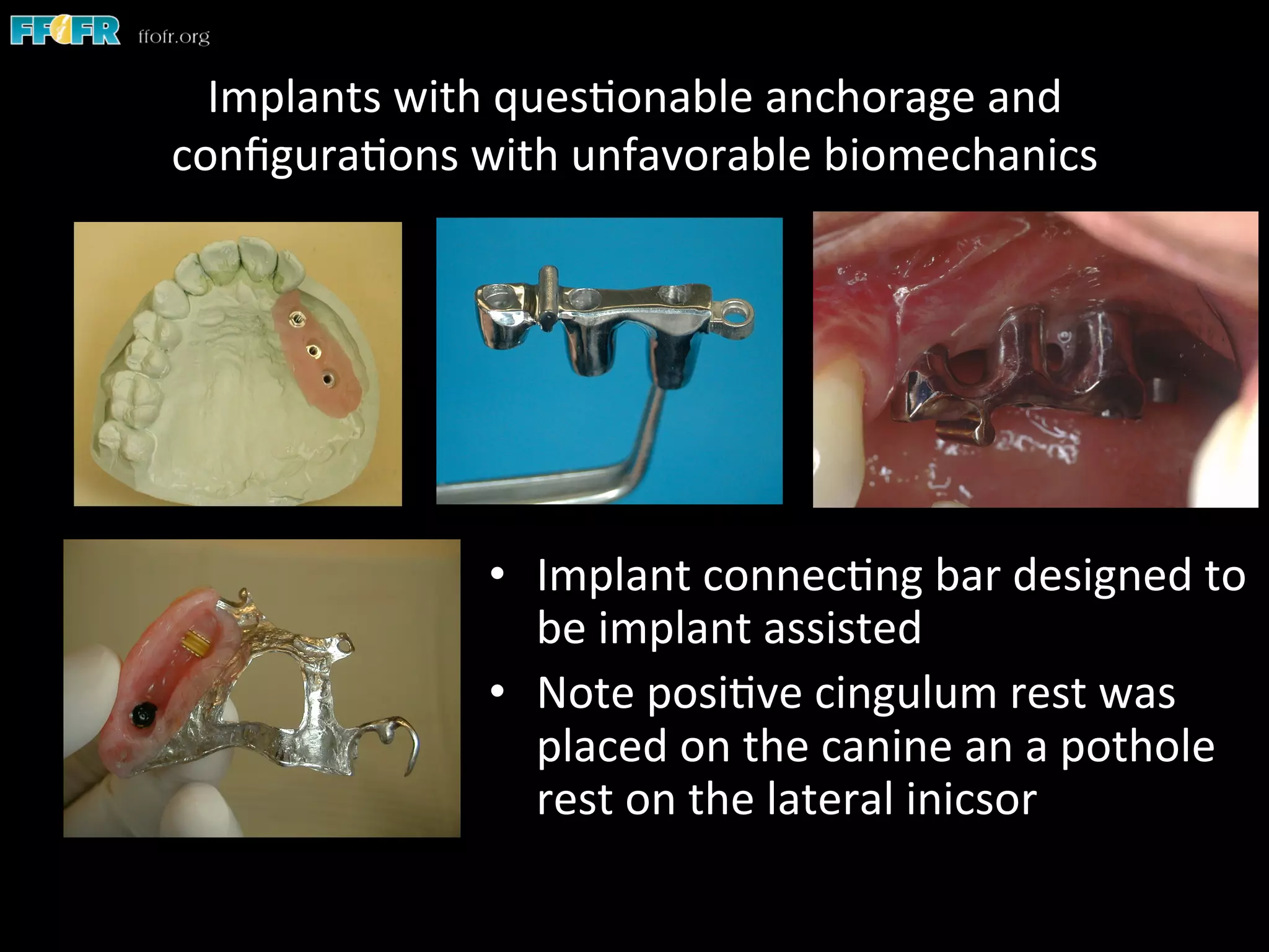 Implants and rp ds | PDF