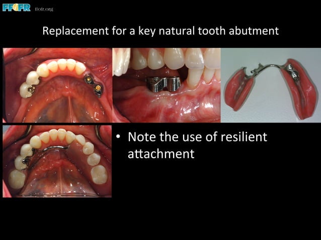 Implants and rp ds | PDF