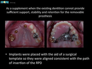 Implants and rp ds | PDF