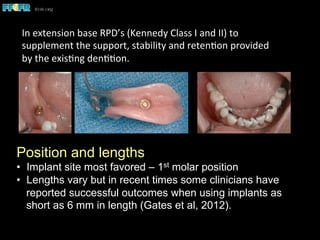 Implants and rp ds | PDF