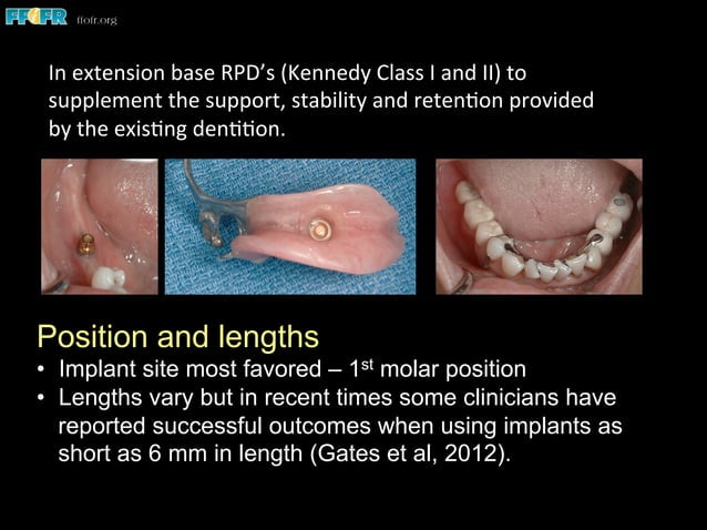 Implants and rp ds | PPT