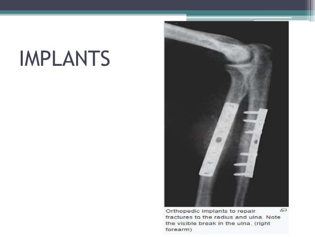 Implants and transdermal patches