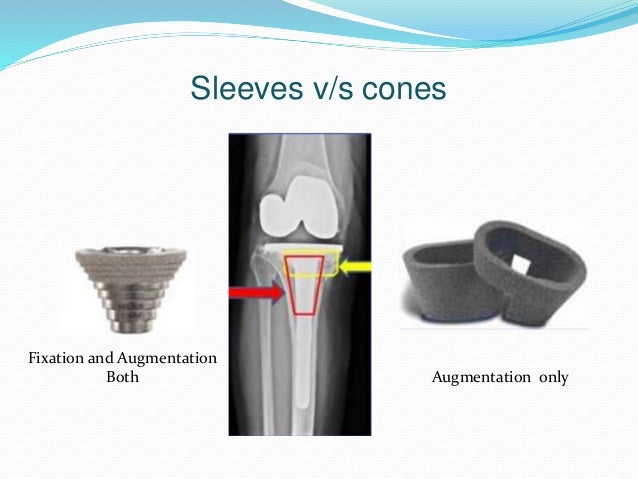 Implant Selection In Revision T.K.R