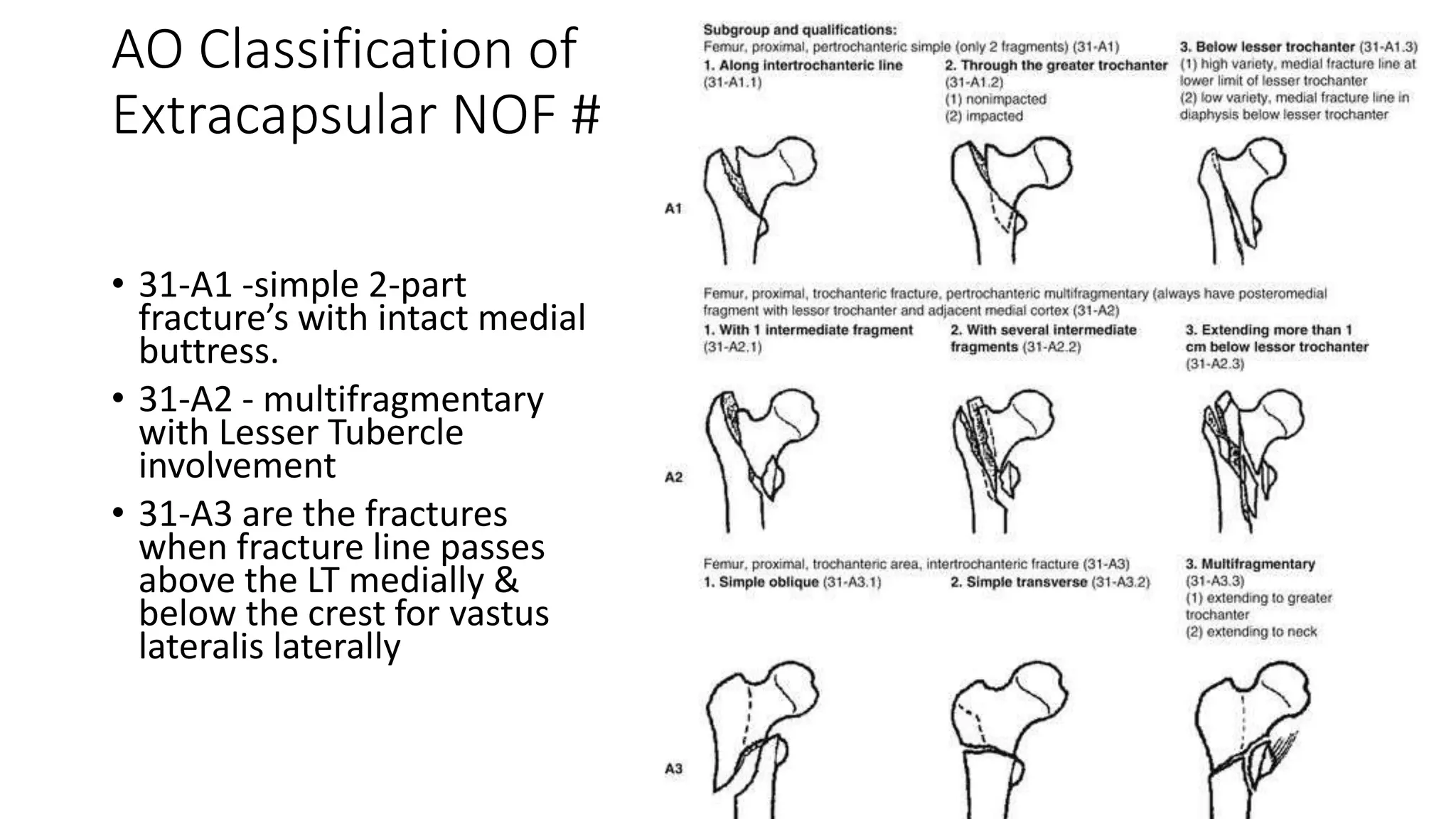Implants for extracapsular neck of femur fracture dynamic | PPTX