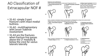 Implants for extracapsular neck of femur fracture dynamic | PPTX